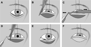 Anterior lamellar deficit ectropion management | Eye