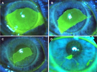 Chemical eye injury: pathophysiology, assessment and management | Eye