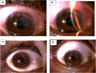 Presumed tuberculous sclerokeratouveitis in immunocompetent South ...