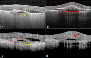 “Choroidal caverns” spectrum lesions | Eye