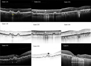 Inter-rater reliability for diagnosis of geographic atrophy using ...