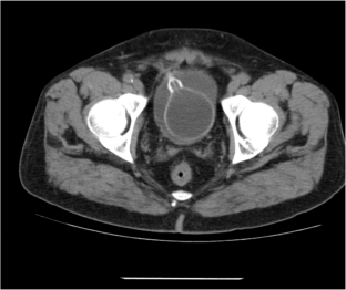 Should occasional implanters learn ectopic placement of IPP reservoirs ...