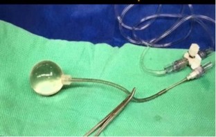 A new paradigm for surgical revision of the artificial urinary ...