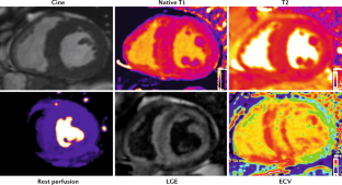 Diagnostic imaging of cardiac amyloidosis | Nature Reviews Cardiology