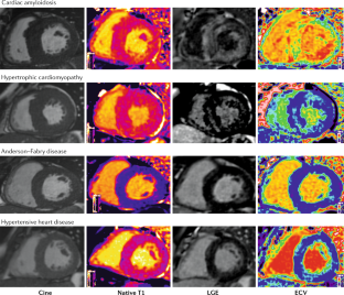 Diagnostic imaging of cardiac amyloidosis | Nature Reviews Cardiology