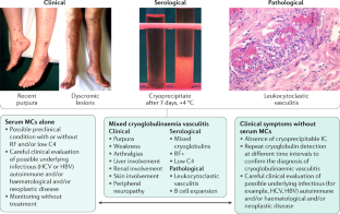 Cryoglobulinaemia | Nature Reviews Disease Primers