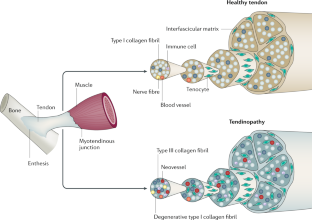 Tendinopathy | Nature Reviews Disease Primers