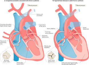 Turner syndrome: mechanisms and management | Nature Reviews Endocrinology