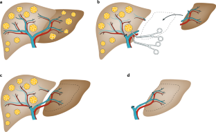 Modern therapeutic approaches for the treatment of malignant liver ...