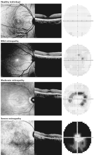 Hydroxychloroquine retinopathy — implications of research advances for ...