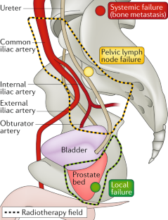 Salvage therapy at biochemical recurrence of prostate cancer | Nature ...