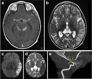 Tuberculous meningitis: a roadmap for advancing basic and translational ...