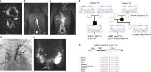 ARAF recurrent mutation causes central conducting lymphatic anomaly ...