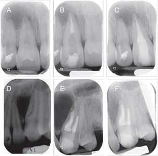 Dens invaginatus: diagnosis and management strategies | British Dental ...