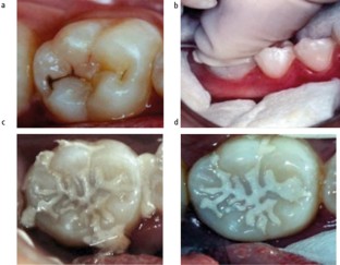 Atraumatic restorative treatment and minimal intervention dentistry ...
