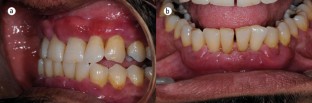 Gingival overgrowth: Part 1: aetiology and clinical diagnosis | British ...
