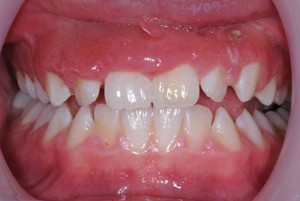 Gingival overgrowth: Part 1: aetiology and clinical diagnosis | British ...