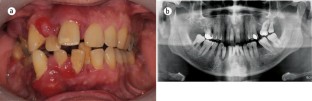 Gingival overgrowth: Part 1: aetiology and clinical diagnosis | British ...