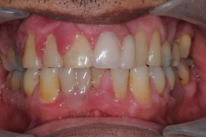 Gingival overgrowth: Part 1: aetiology and clinical diagnosis | British ...