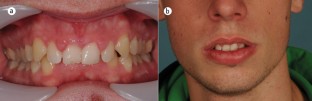 Gingival overgrowth: Part 1: aetiology and clinical diagnosis | British ...