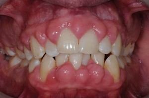 Gingival overgrowth: Part 1: aetiology and clinical diagnosis | British ...