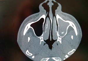 Oral surgery II: Part 2. The maxillary sinus (antrum) and oral surgery ...