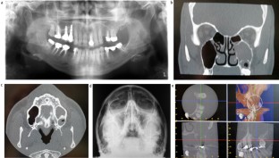 Oral surgery II: Part 2. The maxillary sinus (antrum) and oral surgery ...