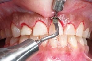A guide to minimally invasive crown lengthening and tooth preparation ...