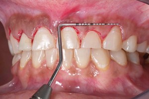 A guide to minimally invasive crown lengthening and tooth preparation ...