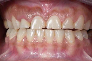 A guide to minimally invasive crown lengthening and tooth preparation ...