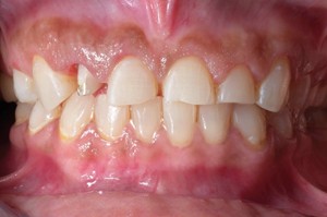 A guide to minimally invasive crown lengthening and tooth preparation ...
