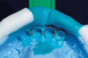 A guide to minimally invasive crown lengthening and tooth preparation ...