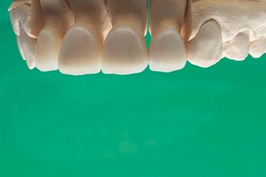 A guide to minimally invasive crown lengthening and tooth preparation ...