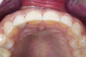 A guide to minimally invasive crown lengthening and tooth preparation ...