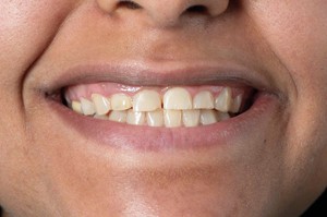 A guide to minimally invasive crown lengthening and tooth preparation ...