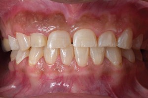 A guide to minimally invasive crown lengthening and tooth preparation ...