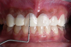 A guide to minimally invasive crown lengthening and tooth preparation ...