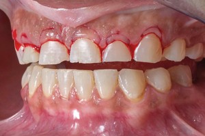 A guide to minimally invasive crown lengthening and tooth preparation ...