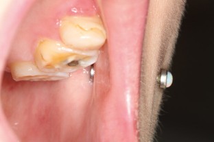 Oral piercings and their complications – how confident are we as a ...