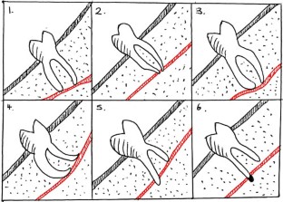 Coronectomies: assessment and treatment planning | British Dental Journal