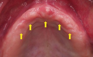 Five steps to flabby ridge success | British Dental Journal