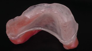 Five steps to flabby ridge success | British Dental Journal