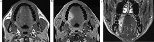 Imaging patients with cancer of the oral cavity | British Dental Journal