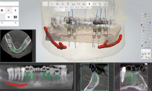 Digital implant planning and guided implant surgery – workflow and ...