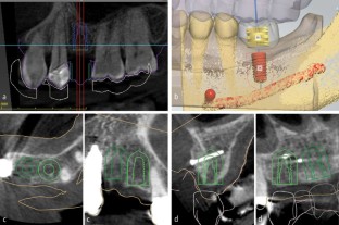 Digital implant planning and guided implant surgery – workflow and ...