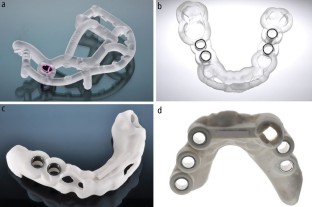 Digital implant planning and guided implant surgery – workflow and ...