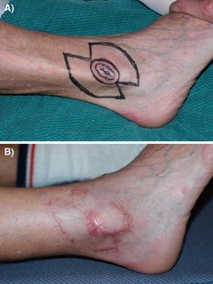 Keystone Flap Reconstruction of Primary Melanoma Excision Defects of ...