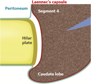 Laparoscopic Right Hemihepatectomy Using the Glissonean Approach ...