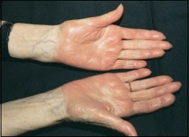 Antineoplastic Therapy—Induced Palmar Plantar Erythrodysesthesia (‘Hand ...