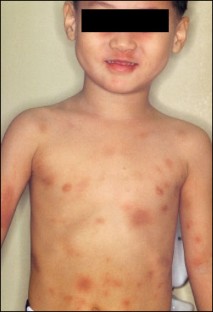 Fixed Drug Eruptions | SpringerLink